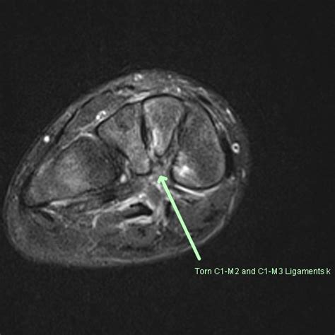 Lisfranc Fracture Dislocation Mri Online Medality