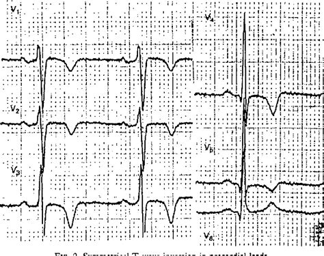 Figure 1 From Intermittent Left Bundle Branch Block Revealed During Anaesthesia Semantic Scholar
