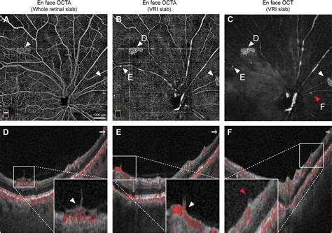 Early Sign Of Retinal Neovascularization Evolution In Diabetic