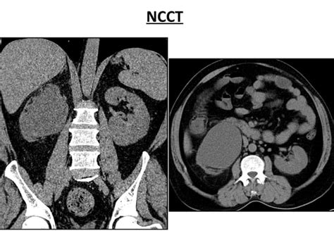 Robotic Assisted Laparoscopic Right Nephrectomy Ppt