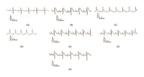 The Traces Of The Ecg In Each Group Rats Were Subjected To 30 Min Of Download Scientific