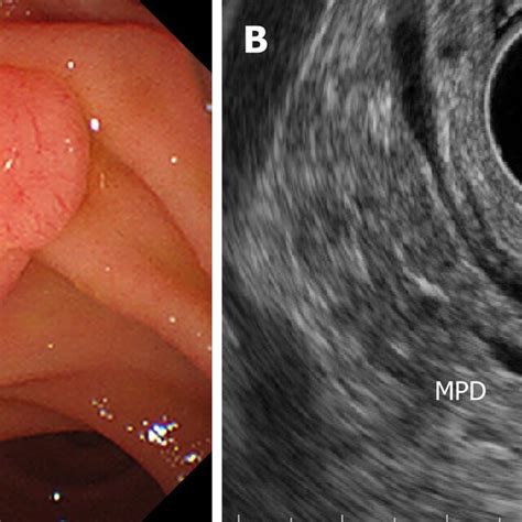 A Case Of Ampullary Adenoma That Was Indicated For Endoscopic Download Scientific Diagram