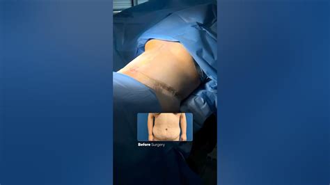 Behind The Scenes Extended Fdl Tummy Tuck And Waist Liposuction