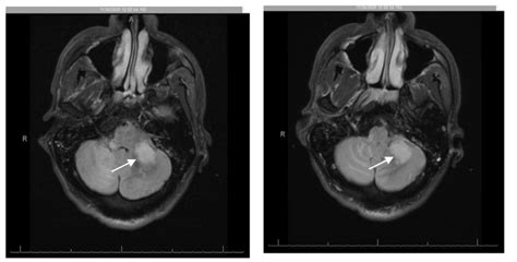 Immune Reconstitution Inflammatory Syndrome With Recurrent Paradoxical Cerebellar Hiv Associated