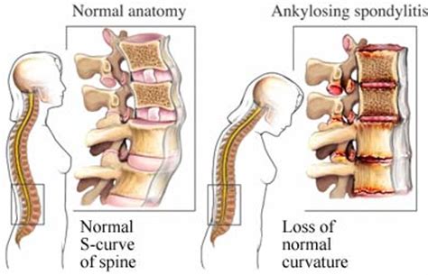Ankylosing Spondylitis Spine Specialist Singapore Sports
