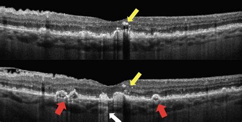 Outer Retinal Hyperreflective Foci Linked To Late AMD Progression