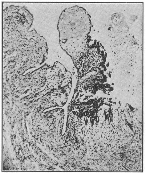 Figure 1 From Primary Carcinoma Of The Fallopian Tube Semantic Scholar