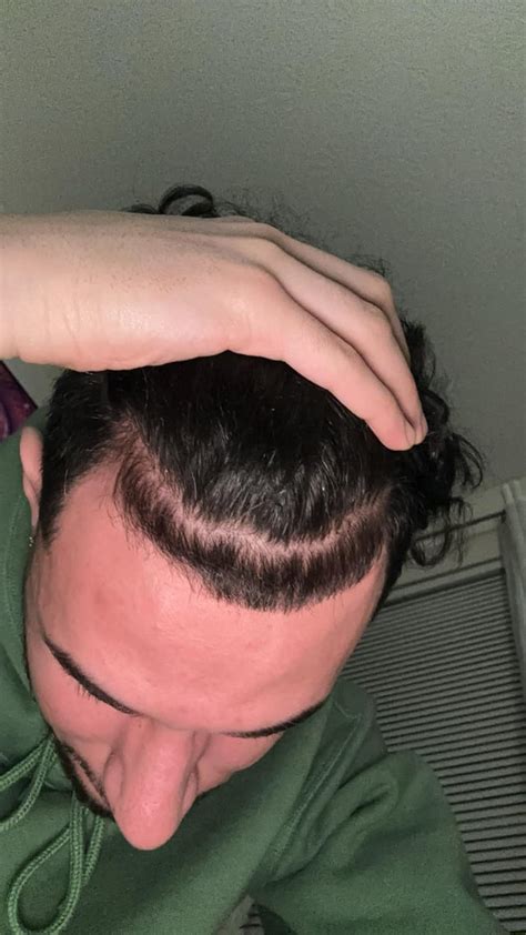 Is My Hairline Receding Rhair