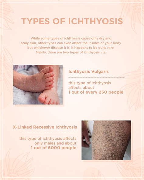 Flickriver Most Interesting Photos Tagged With Ichthyosis