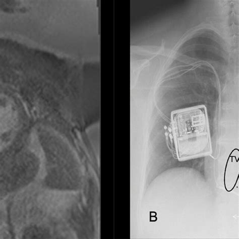 Ccm Implantation And Placement Of Leads According To Aha Segment Model