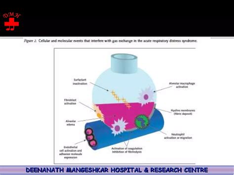 Ards Patho Physiology 1pptx
