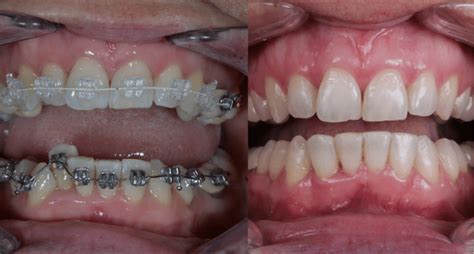 Fixed Metal Braces Absolute Dental Dentist In Cardiff And Kingsbridge