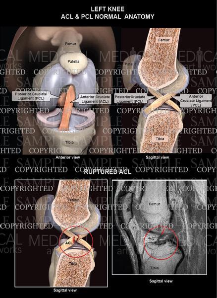 Normal Acl And Pcl Left Knee Anatomy Ruptured Acl Mri Of Ruptured Acl