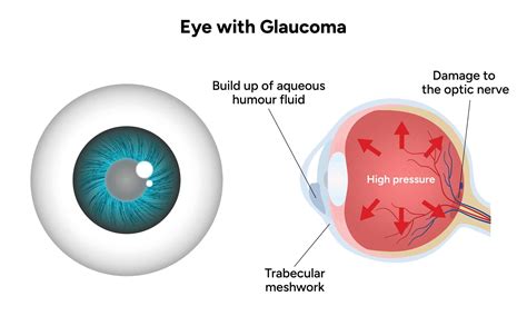 Understanding Glaucoma Types And Awareness Guide