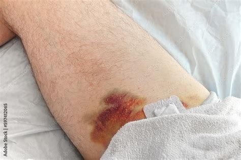 Hematoma On A Mens Leg Close Up Huge Bruise On The Leg Of A Man After