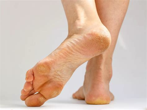 Corns And Calluses In Burbank Northridge And Santa Clarita Los Angeles
