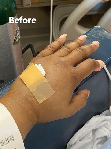 Before And After Iv Infiltration Rbeforeandafter