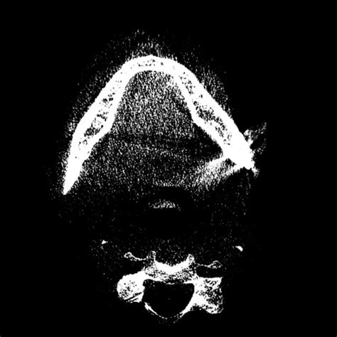 Midface 2 Lower Democratiz3d® Processing