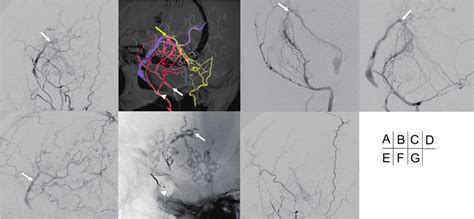 A The Right Eca Angiogram Lateral View Showing An Av Shunt Arrow