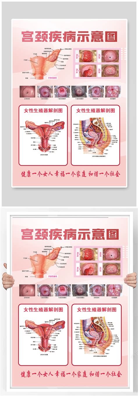 宫颈示意图素材 宫颈示意图模板 宫颈示意图设计图片免费下载 众图网
