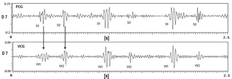 Example Of Wavelet Decomposition Detail D7 On Pcg Top And Vcg Download Scientific Diagram