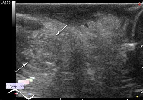 Testicular Microlithiasis Microcalcification Scrotum Sonography Clinical Report Video