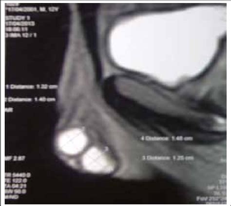 Crossed Ectopia Detected In Mri Sagittal T2 Weighted Image Shows