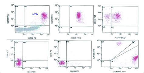 Flow Cytometry On Pleural Fluid Shows An Abnormal Population Of