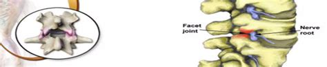Facet Arthritis Dr Mahmood Ahmad