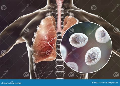Pneumocystis Jirovecii Opportunistic Fungus That Causes Pneumonia In