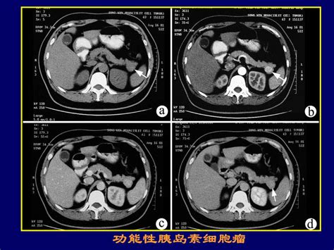 胰腺常见病变的ct诊断 影像ppt