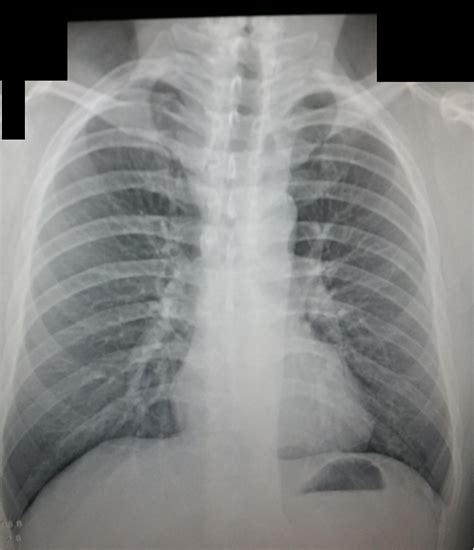 Question About Hilum Area On Cxr Are The Markings On The Left Just