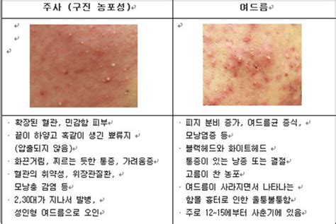 임산부 얼굴에 생긴 여드름과 늦은 후회