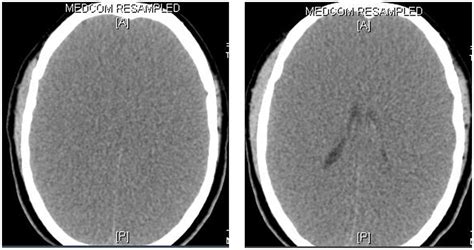 Frontiers Ancillary Tests For Brain Death
