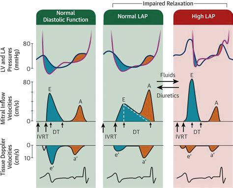 Left Ventricular Diastolic Function Understanding Pathophysiology