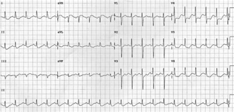Ischemic Heart Disease Clin Med Flashcards Quizlet