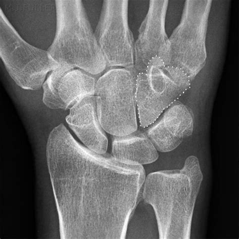 Ulna Hairline Fracture