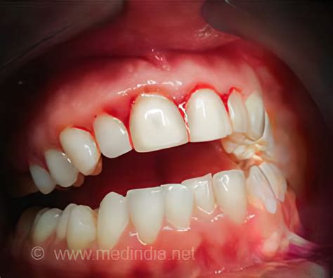 Gingival Hyperplasia