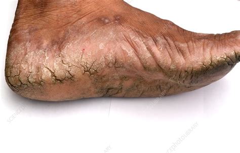 Hyperkeratosis Of The Foot Stock Image C037 2078 Science Photo