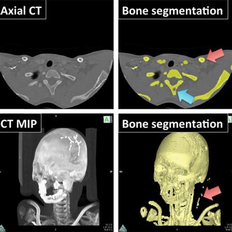 Automatic Segmentation Of Head CT Dataset Top Segmentation Results