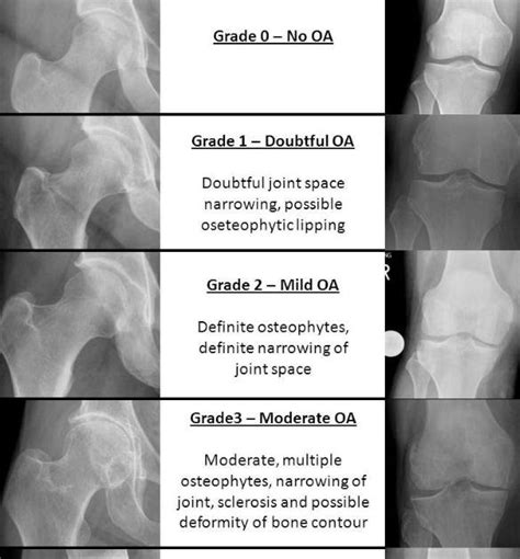 Visão Radiológica Classificação De Osteoartrose Kellgren Lawrence