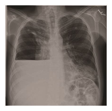 Chest X Ray After Thoracentesis Showing Large Right Pneumothorax With