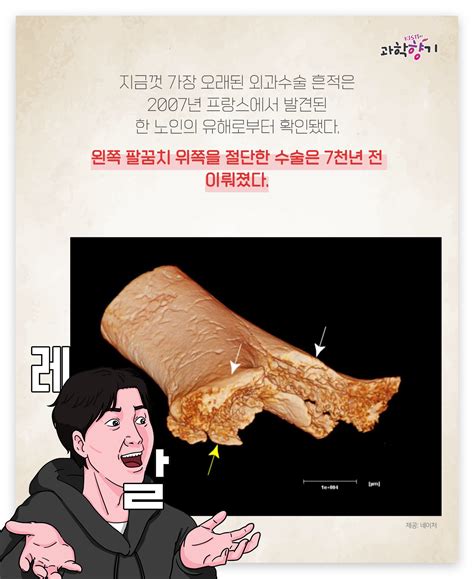 3만1천 년 전에 이미 다리 절단을 흥미로운 수술의 역사 살펴보기 Kisti의 과학향기