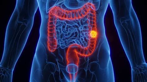 Cáncer colorrectal: cómo se explica el aumento de los casos de esta enfermedad entre las ...