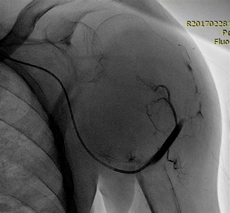 Left Humeral Hypervascular Metastasis From Hepatocellular Carcinoma