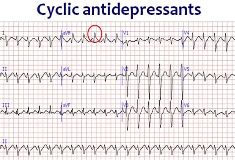 Neuropathic Pain Neuropathic Pain Tca