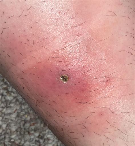 What Kind Of Bug Bite Is This My Friend Got Bit On His Leg And Is