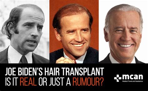 Everything About Joe Biden Hair Transplant