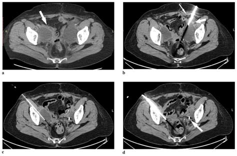 Ct Guided Procedures An Initial Experience Pmc