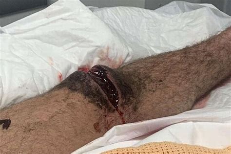 Dads Knee Split In Half In Horror Footballing